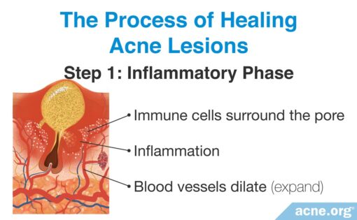 How Do Acne Lesions Heal? - Acne.org