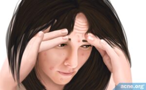 Alcohol and Acne - Acne.org