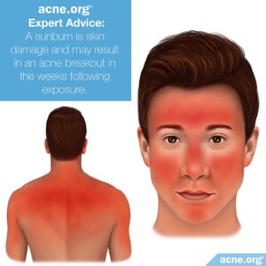 Does the Sun Help or Hurt Acne? - Acne.org