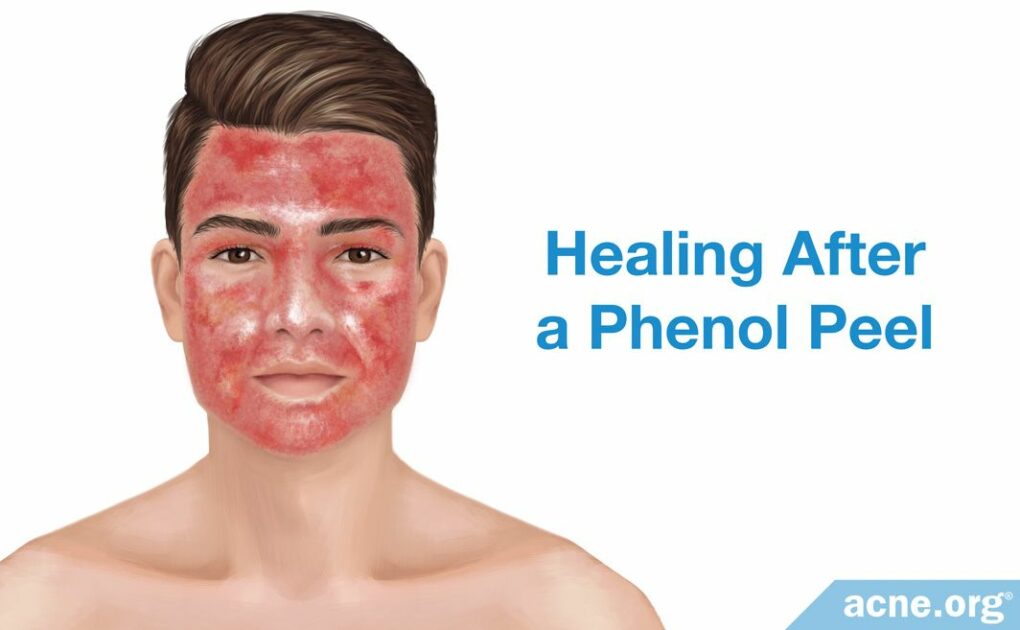 Chemical Peels for Acne - Acne.org