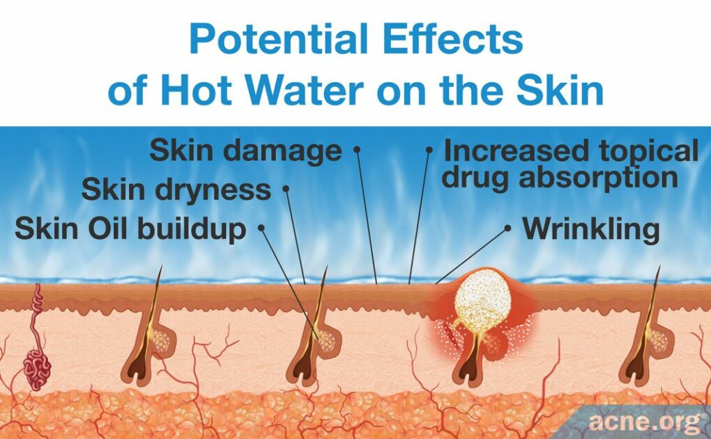 Should You Wash Your Skin with Hot or Cold Water? - Acne.org