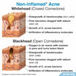 What Is the Difference Between Inflamed and Non-inflamed Acne? - Acne.org