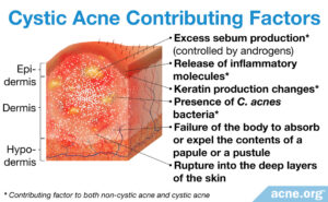 Regular Acne vs. Cystic Acne: What's the Difference? - Acne.org