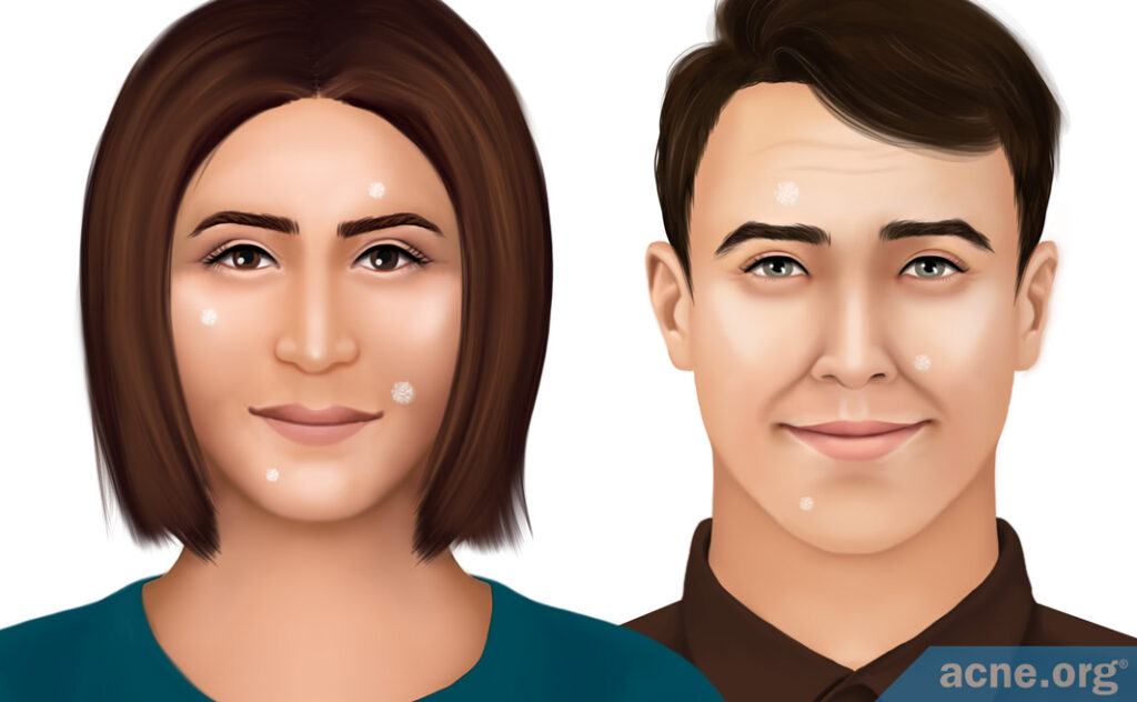 Adult Acne - Acne.org