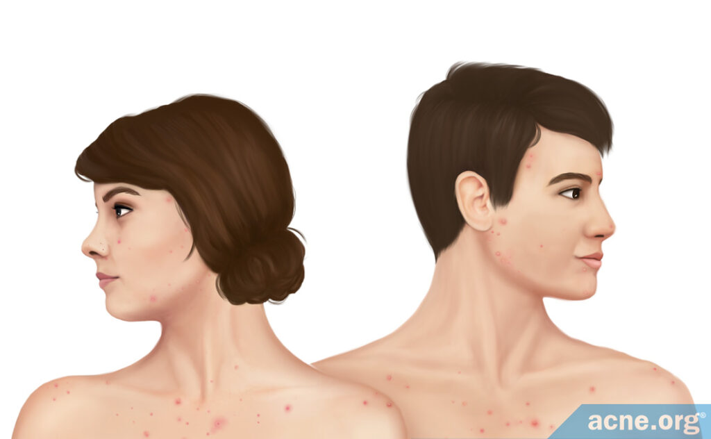 Adult Acne: Understanding the Causes and Effects - Acne.org