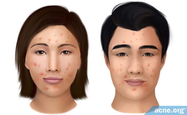 Asian Skin and Acne - Acne.org