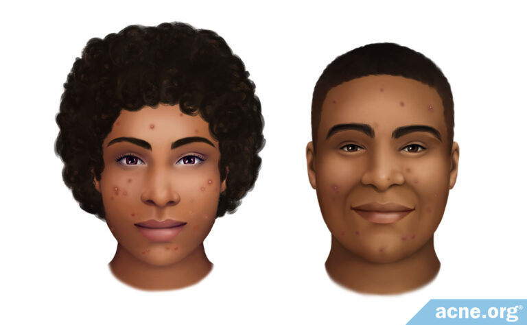 Black Skin and Acne - Acne.org