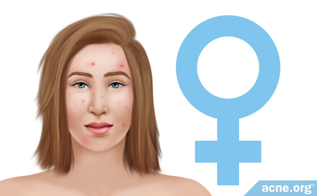 Female Acne - Acne.org