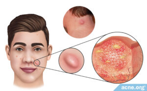 What Is an Acne Nodule? - Acne.org
