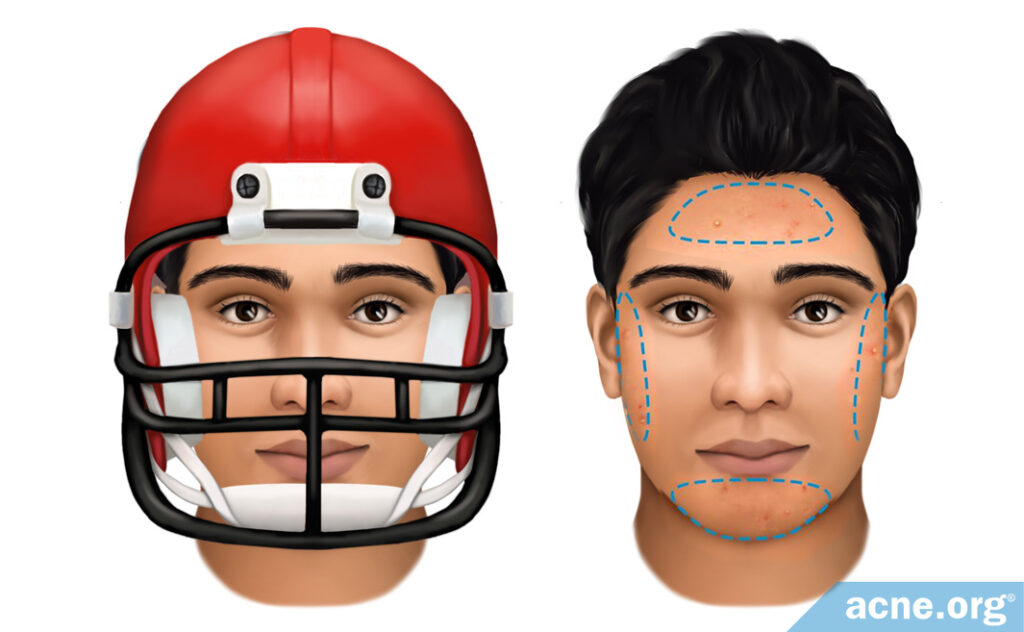 What is Acne Archives - Acne.org