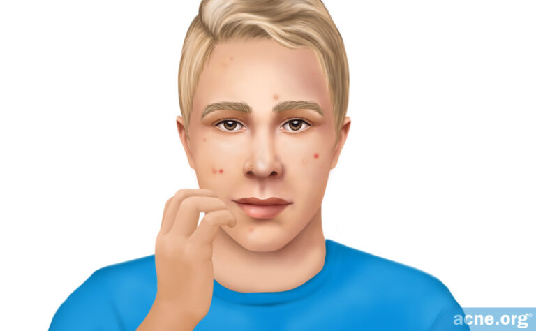 What is Acne Archives - Acne.org