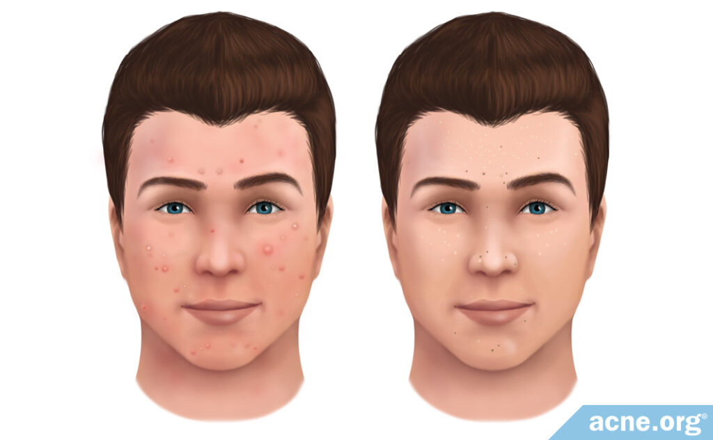 What Is the Difference Between Inflamed and Non-inflamed Acne? - Acne.org