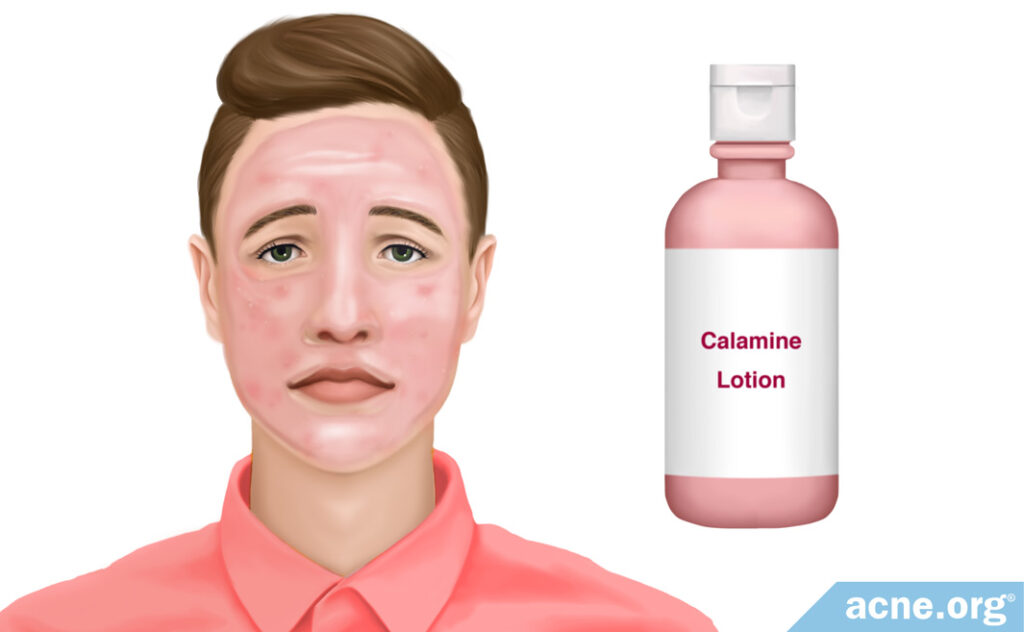 Does Calamine Lotion Clear Acne? - Acne.org