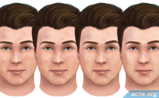 How Do Acne Lesions Heal? - Acne.org