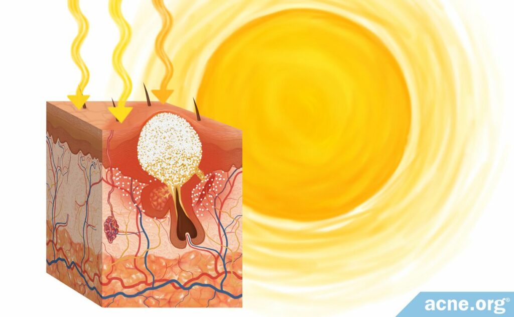 Does the Sun Help or Hurt Acne? - Acne.org