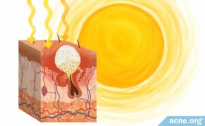 Does the Sun Help or Hurt Acne? - Acne.org