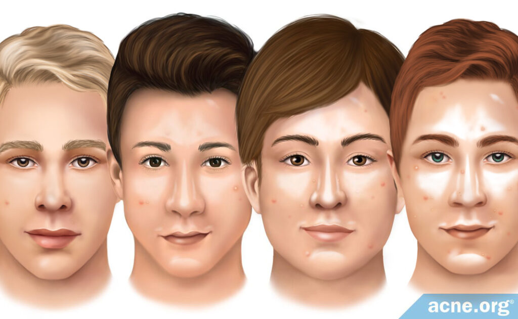 Oily Skin Archives - Acne.org