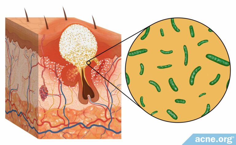 The Role of Bacteria in Acne - Acne.org