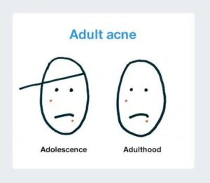 Adult Acne - Acne.org