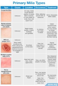 What Are Milia, and Do They Relate to Acne? - Acne.org