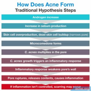 What Is Acne? In-Depth Science & Inflammation Guide