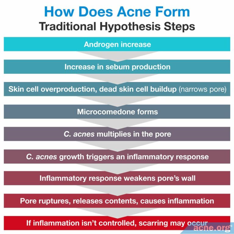 What Is Acne - An In-depth Look - Acne.org