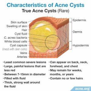 What Is an Acne Cyst? - Acne.org