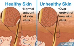 The Role of Skin Cell Overgrowth (Hyperkeratinization) in Acne - Acne.org