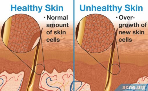 The Role of Skin Cell Overgrowth (Hyperkeratinization) in Acne - Acne.org
