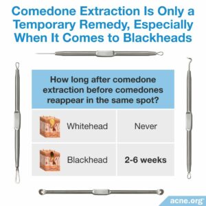 What Is Comedone Extraction, and Should You Do It? - Acne.org