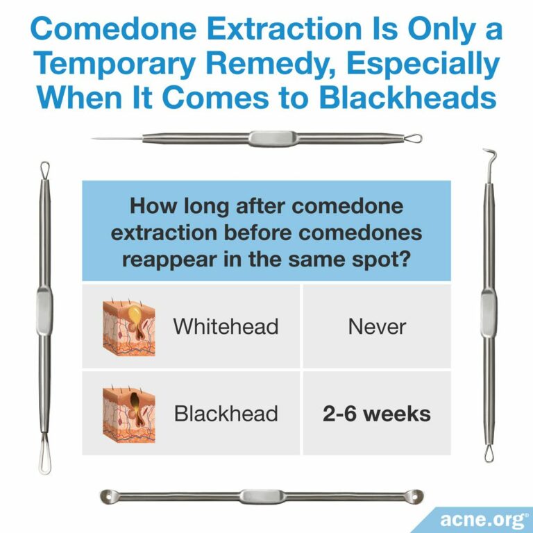 What Is Comedone Extraction, and Should You Do It? - Acne.org