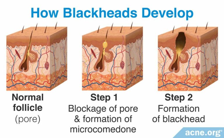 What Is a Blackhead? - Acne.org