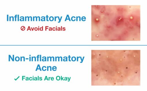 Is Getting a Facial Good for Acne? - Acne.org