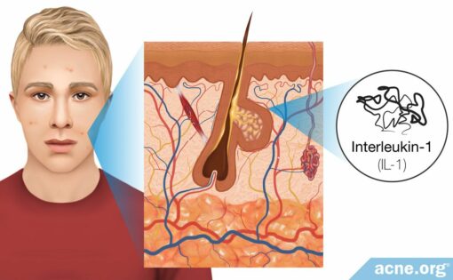 What Is Acne - An In-depth Look - Acne.org