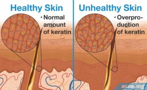 The Role of Skin Cell Overgrowth (Hyperkeratinization) in Acne - Acne.org
