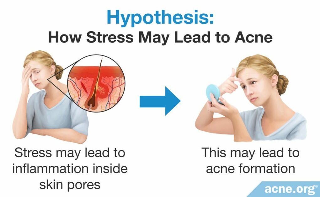 Women, Stress, and Acne - Acne.org