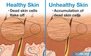 The Role of Skin Cell Overgrowth (Hyperkeratinization) in Acne - Acne.org