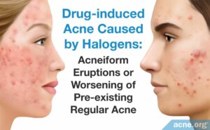 Medications That Cause Acne: Common Culprits Explained - Acne.org