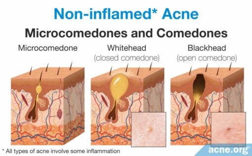 What Is Acne - An In-depth Look - Acne.org