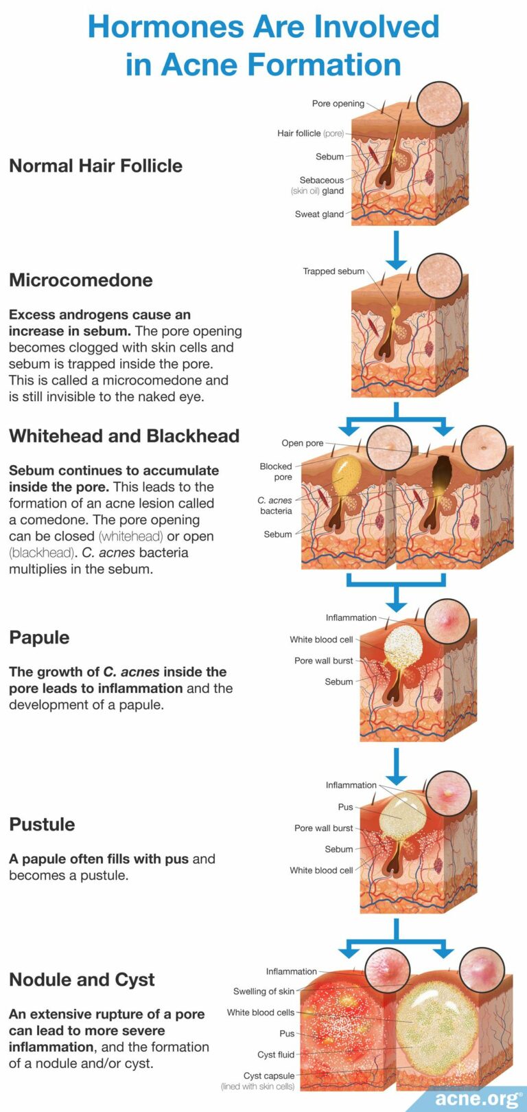Hormones and Cystic Acne: Effective Treatment Options - Acne.org