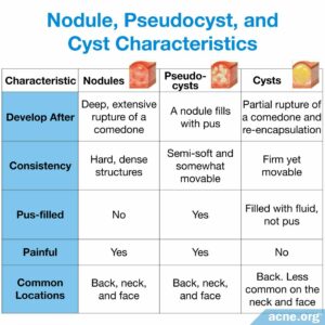 What Is an Acne Cyst? - Acne.org