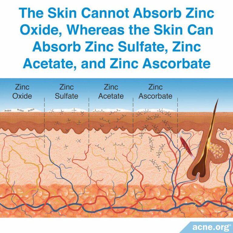Can Topical Zinc Improve Acne? - Acne.org