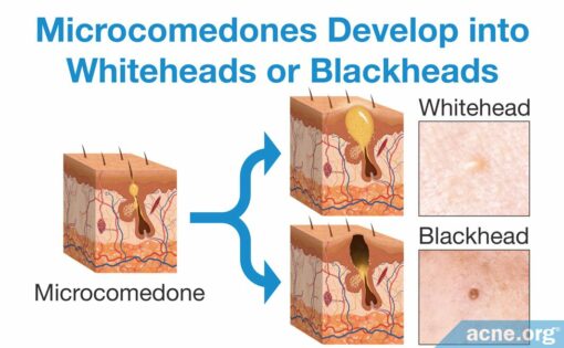 What Is Comedone Extraction, and Should You Do It? - Acne.org