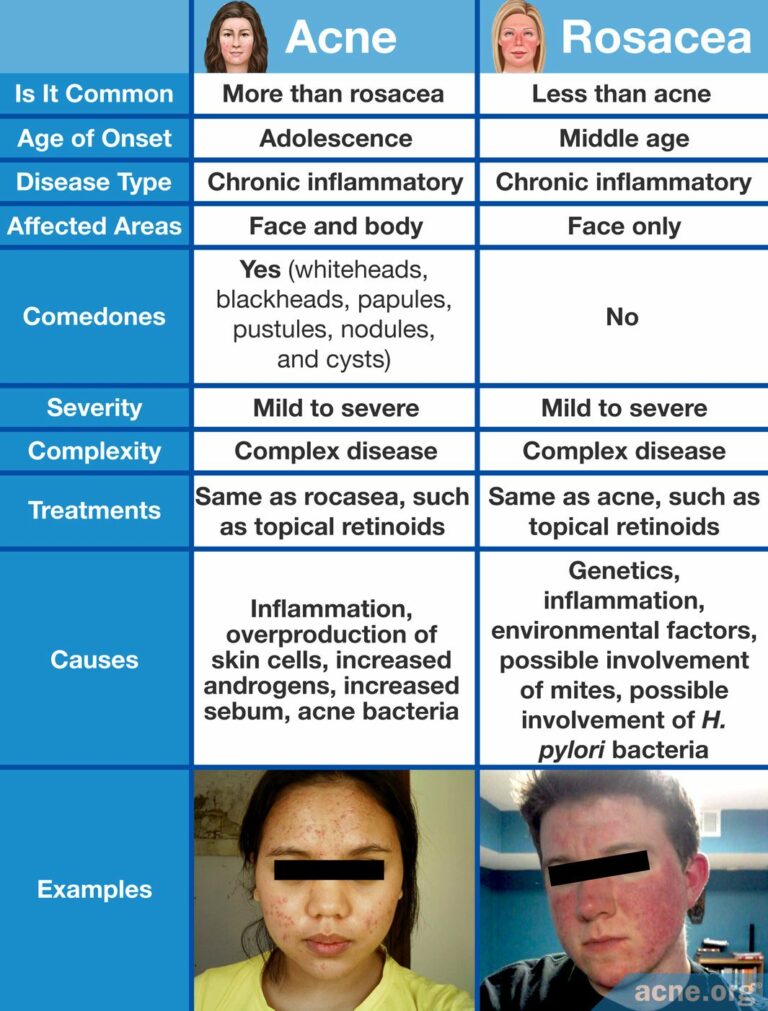 Acne vs. Rosacea - Acne.org