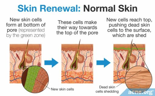 Acne In-depth: How Dead Skin Cell Accumulation Can Lead to Acne - Acne.org