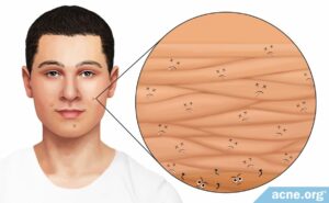Acne In-depth: How Dead Skin Cell Accumulation Can Lead to Acne - Acne.org