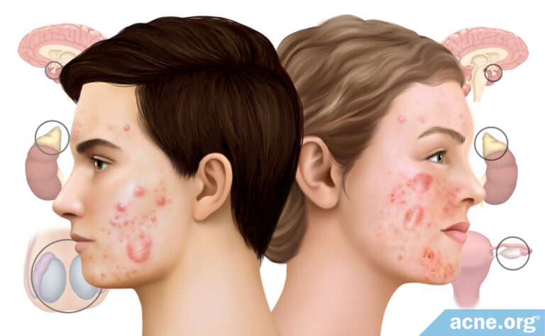 Cystic Acne Archives - Acne.org