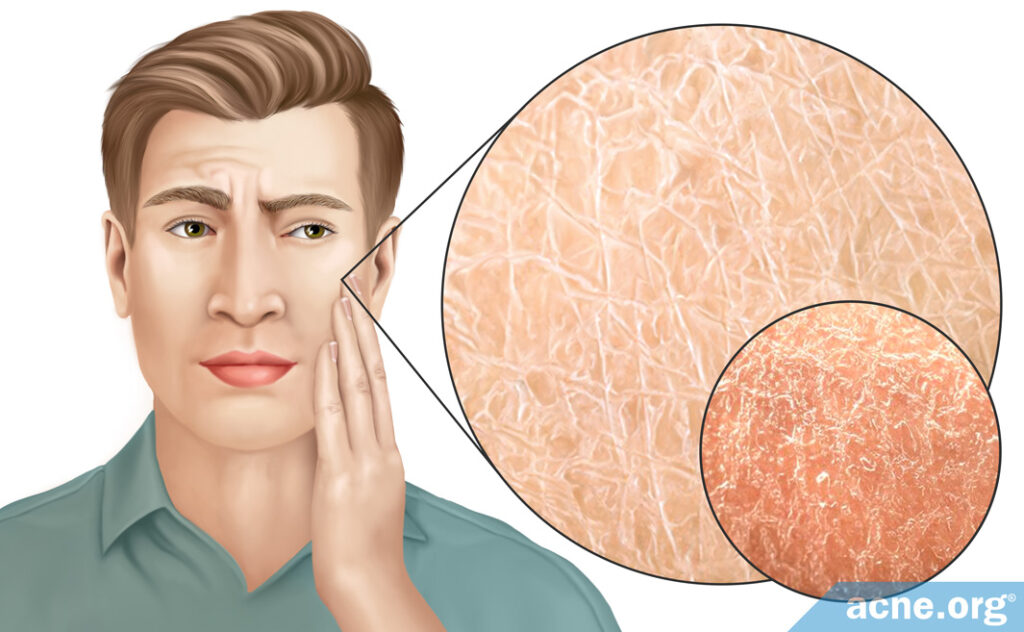 Dry Skin: Causes and Treatments - Acne.org