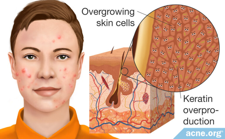 The Role of Skin Cell Overgrowth (Hyperkeratinization) in Acne - Acne.org