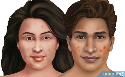 Acne on Indian Skin: Causes & Treatments | Acne.org